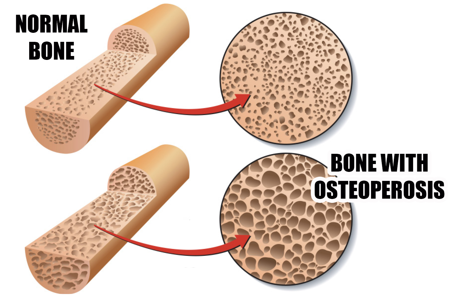 Exercises for Osteoporosis – Ayoti Technologies